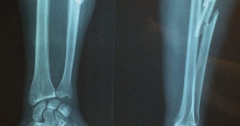 First aid - Fractures (broken bones) - FrontlineER Dallas