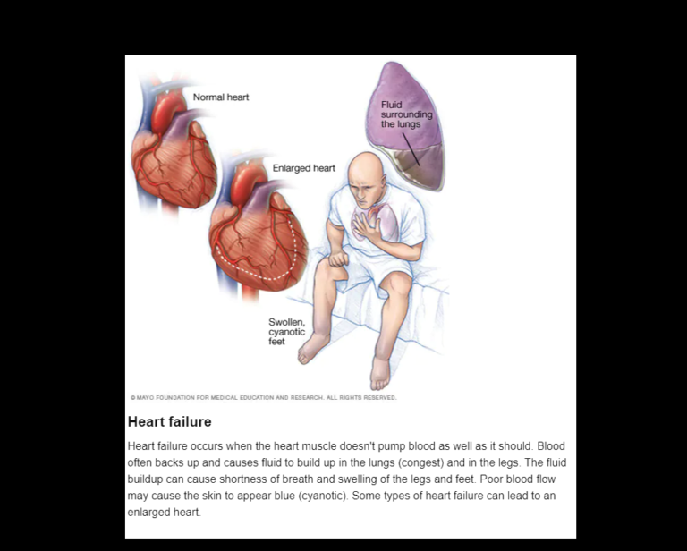 What Are the Early Symptoms of Heart Failure? - FrontlineER Dallas